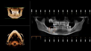 CT Scans & 3-D Views of the Jaws